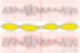 ECG 초보 탈출하기 : Ventricular tachycardia(심실빈맥, V-tach) : 네이버 블로그