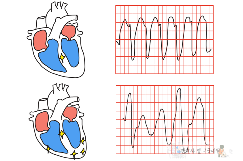 ECG 초보 탈출하기 : Ventricular tachycardia(심실빈맥, V-tach) : 네이버 블로그