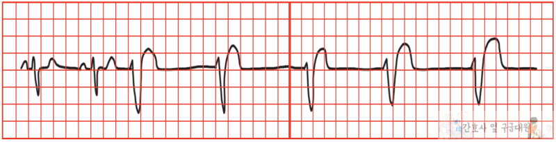 ECG 초보 탈출하기 : Ventricular tachycardia(심실빈맥, V-tach) : 네이버 블로그