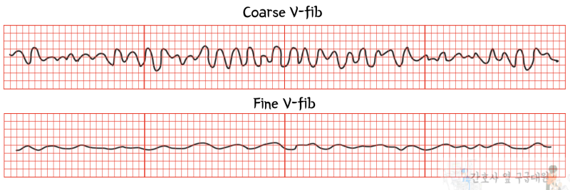 CPR이 필요한 ECG rhythm : pulseless V-tach, V-fib, PEA, Asystole : 네이버 블로그