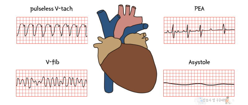 CPR이 필요한 ECG rhythm : pulseless V-tach, V-fib, PEA, Asystole : 네이버 블로그