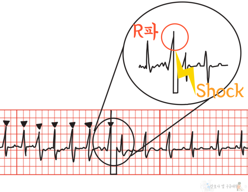 제세동 관련 용어 정의 : Cardioversion vs Defibrillation : 네이버 블로그