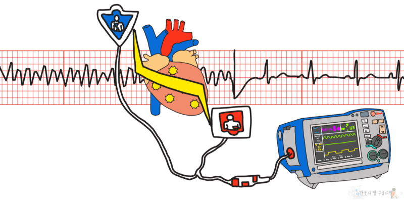 제세동 관련 용어 정의 : Cardioversion vs Defibrillation : 네이버 블로그