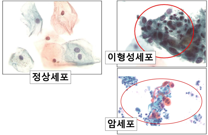 자궁경부 비정형편평상피세포 이상 치료여부 결정 기준 네이버 블로그