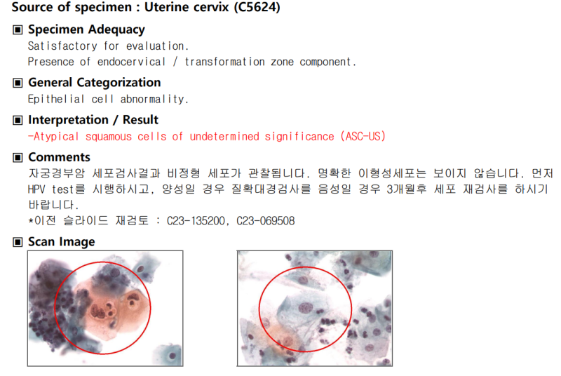 자궁경부 비정형편평상피세포 이상 치료여부 결정 기준 네이버 블로그