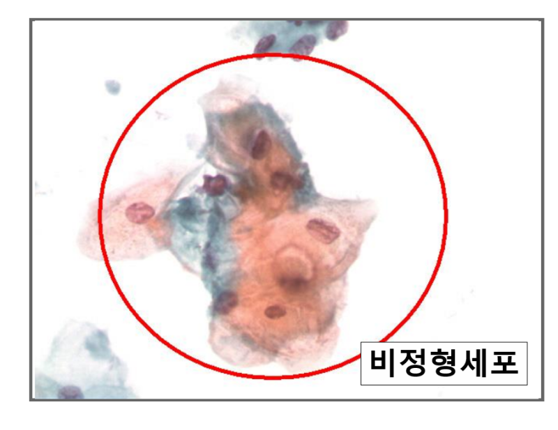 자궁경부 비정형편평상피세포 이상 치료여부 결정 기준 네이버 블로그