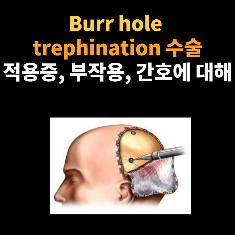 Burr hole trephination (천두술) 수술의 적용증, 부작용, 간호에 대해서 알아봐요~ : 네이버 블로그