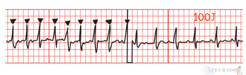 제세동기 사용법 : 임상에서의 Cardioversion vs Defibrillation : 네이버 블로그