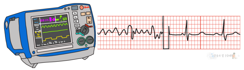 제세동기 사용법 : 임상에서의 Cardioversion vs Defibrillation : 네이버 블로그
