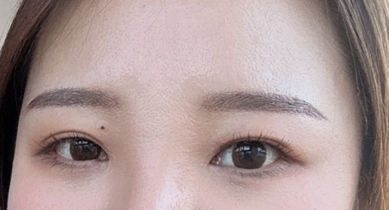 이마주름 보톡스 3회차 시술 내돈내산 리얼 후기효과 부작용 유지기간 네이버 블로그