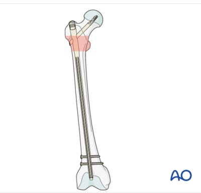 80대 고령 대퇴전자간 골절 언제부터 걸을 수 있을까요? (비전위 Femur Intertrochanteric Fracuture ...