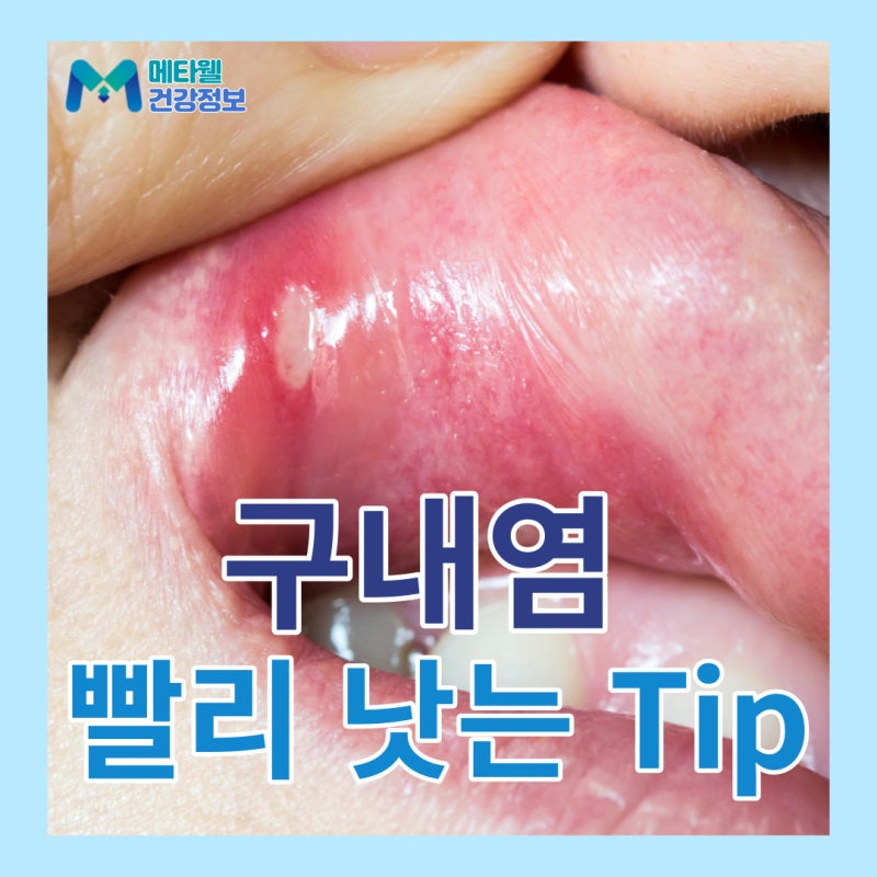 구내염 빨리낫는법 잇몸 부었을때 원인 실제로 효과 본 5가지 방법 Tip 공유 네이버 블로그