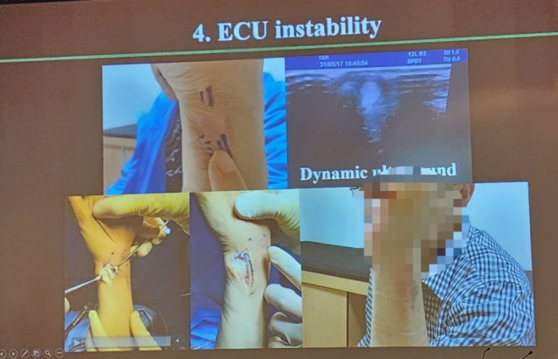 손목 통증 내측 부위 TFCC injury 삼각섬유연골 복합체 손상 치료 : 네이버 블로그