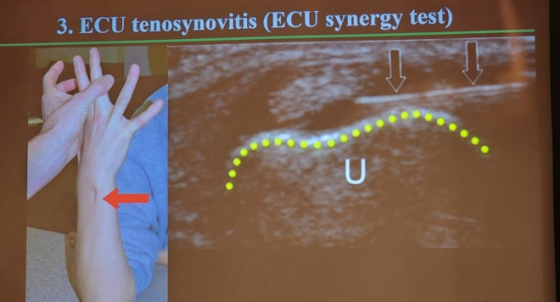 손목 통증 내측 부위 TFCC injury 삼각섬유연골 복합체 손상 치료 : 네이버 블로그