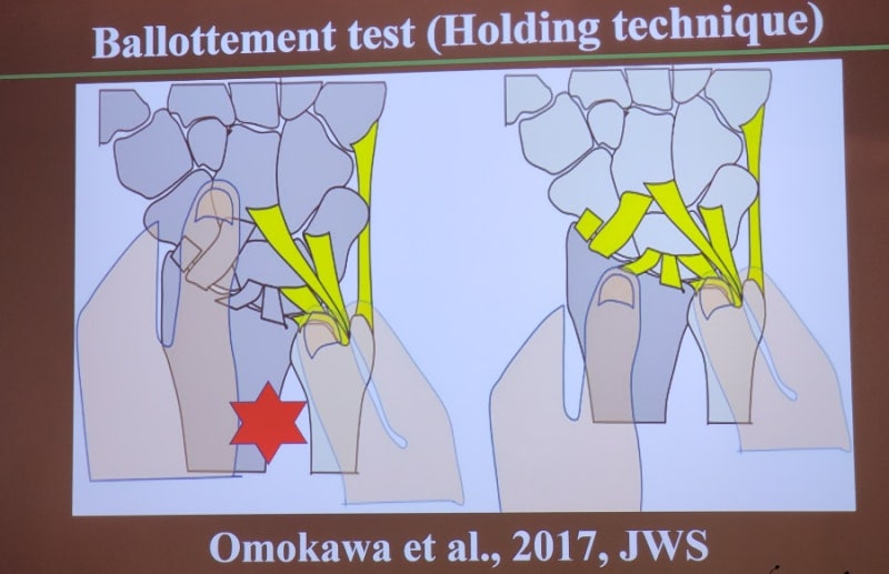 손목 통증 내측 부위 TFCC injury 삼각섬유연골 복합체 손상 치료 : 네이버 블로그