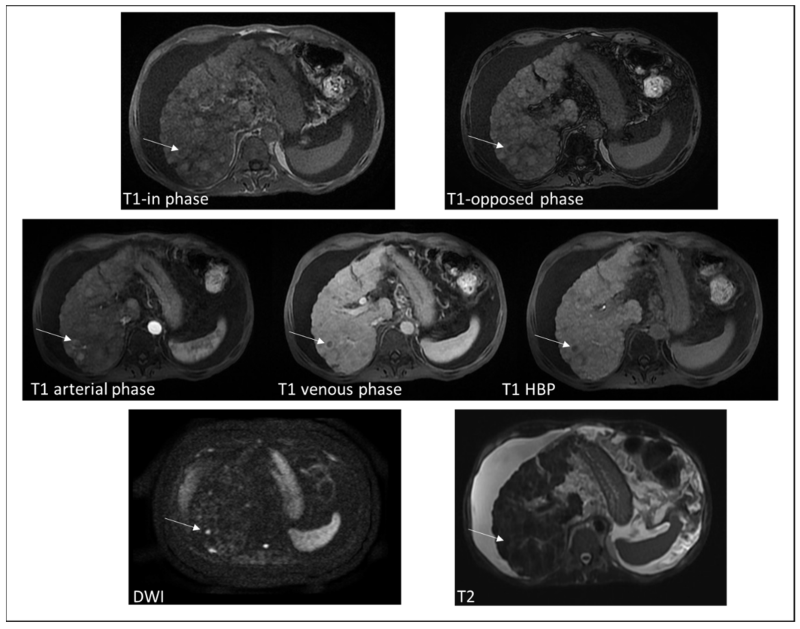 간 MRI(liver MRI) : 네이버 블로그