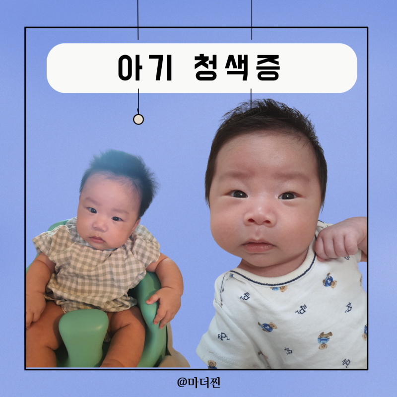 아기 청색증 증상 원인 대처방법 네이버 블로그