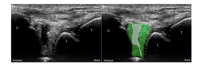 손목 통증 내측 부위 TFCC injury 삼각섬유연골 복합체 손상 치료 : 네이버 블로그