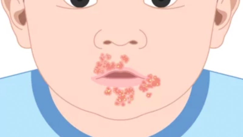 얼굴 피부 입가 마른 버짐 관리 원인 예방 및 치료 방법바세린 네이버 블로그