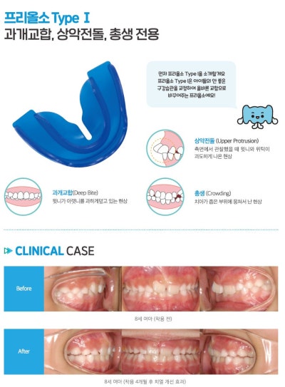 근기능장치 적응증, 치료효과 정리: 프리올쏘 (Preortho), EF line : 네이버 블로그