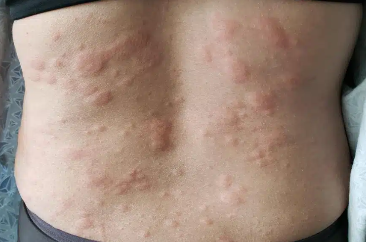 한랭 두드러기 원인 및 증상 팔 다리 얼굴 겨울 알레르기 치료 예방 방법 네이버 블로그