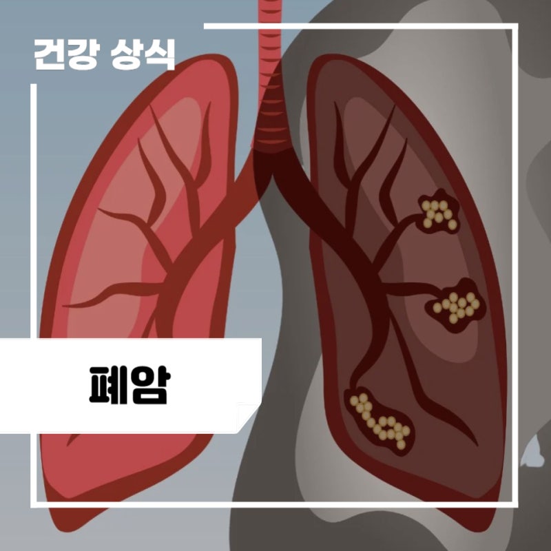 폐암 초기 증상 및 원인 검사방법 치료 1기 2기 3기 4기 생존율 네이버 블로그