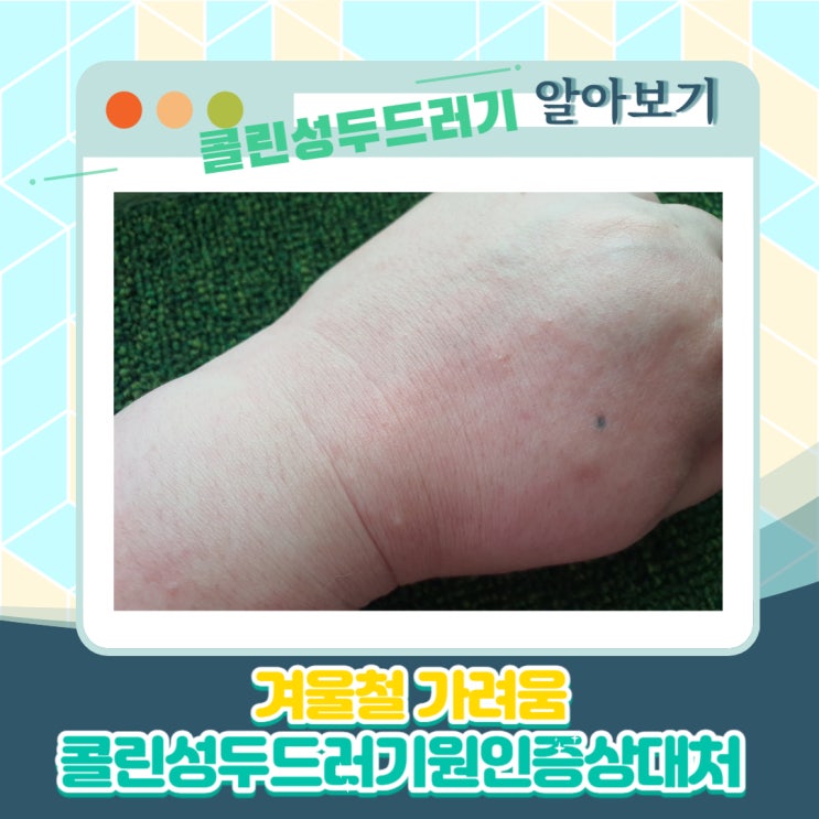 겨울철 외출했다 실내들어가면 가려워요 콜린성두드러기 원인 증상 치료 대처법 알아보기