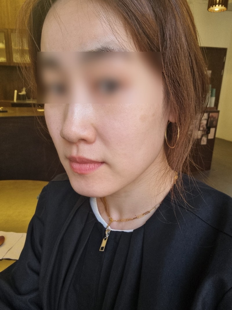대구 티타늄리프팅 시술후기 쁘띠한 변화40대 아줌마 네이버 블로그