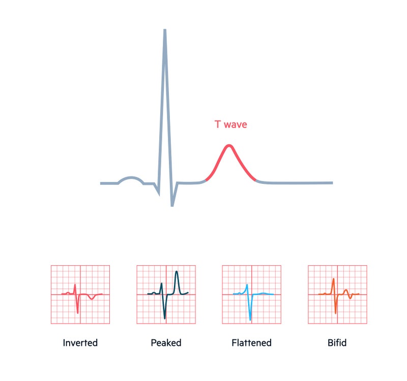 심전도의 원리와 임상적 의미 (EKG, ECG) : 네이버 블로그