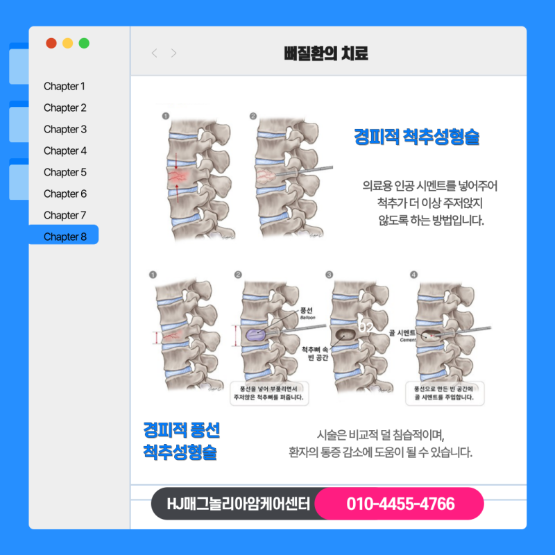 다발골수종 증상 1기 2기 3기 치료법 항암 부작용 완화 집중케어 전이 재발 방지 관리는 경기도암요양병원 Hj