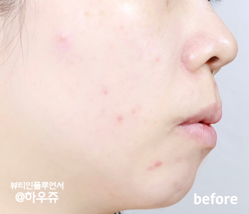 올영추천템 해서린 무통증 마이크로패치 여드름 뾰루지 트러블 스팟케어 네이버 블로그