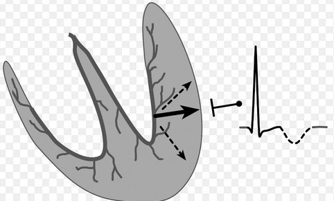 T-wave inversion (T-파 역전) EKG에 대한 임상적의의에 대해서 알아봐요 : 네이버 블로그