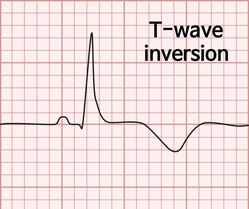 T-wave inversion (T-파 역전) EKG에 대한 임상적의의에 대해서 알아봐요 : 네이버 블로그