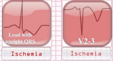 T-wave inversion (T-파 역전) EKG에 대한 임상적의의에 대해서 알아봐요 : 네이버 블로그