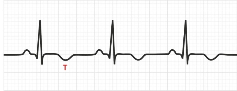 T-wave inversion (T-파 역전) EKG에 대한 임상적의의에 대해서 알아봐요 : 네이버 블로그