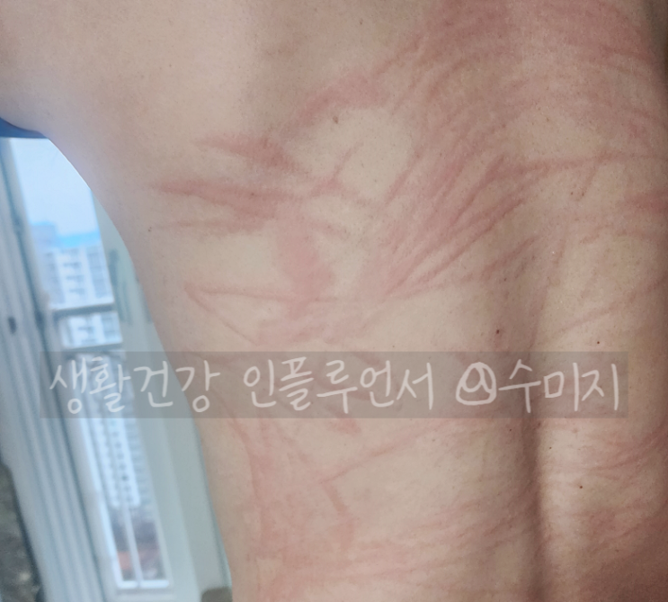먼지 자작나무 꽃가루 알레르기 증상 종류 조개 새우 갑각류 피부 알레르기 반응