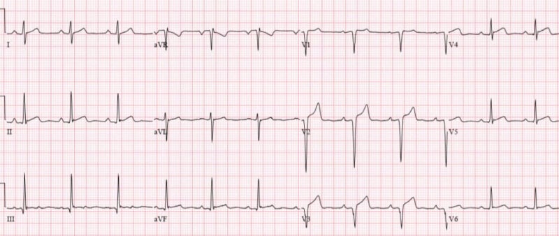 STEMI와 NSTEMI (심근경색, myocardial infarction) : 네이버 블로그
