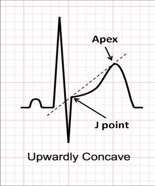 STEMI와 NSTEMI (심근경색, myocardial infarction) : 네이버 블로그