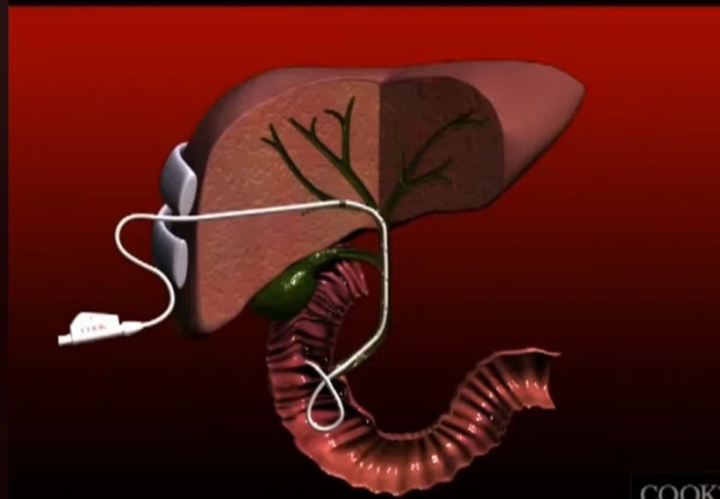 PTBD PTGBD 간호, irrigation, 관리방법 : 네이버 블로그