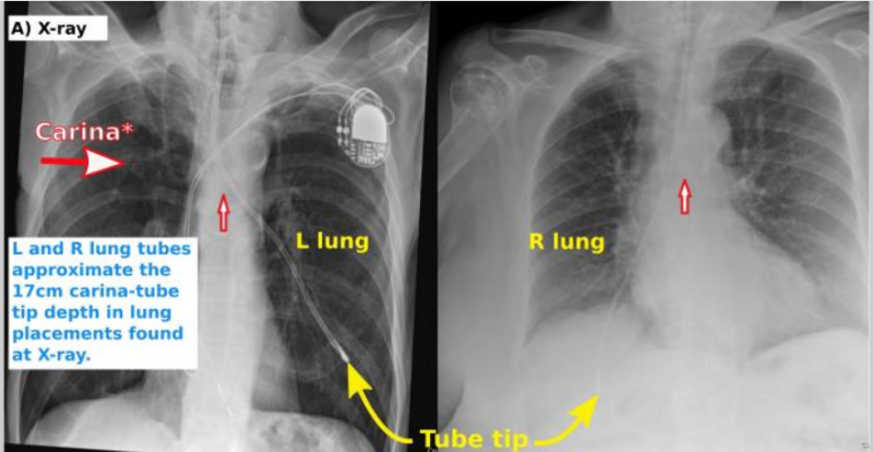 X-ray 상 NG tube(L-tube)의 위치 확인 : 네이버 블로그