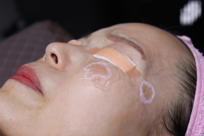 리팟레이저 얼굴 흑자 검버섯제거 내돈내산 후기가격 비용 네이버 블로그