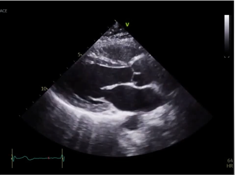 Echo PLAX(parasternal long axis view) 11개 view, LV dimension, M-mode 그 ...