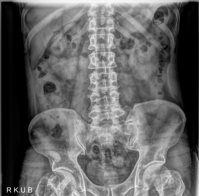 경정맥 신우 조영술 (IVP)로 요로 결석 확인 : 네이버 블로그