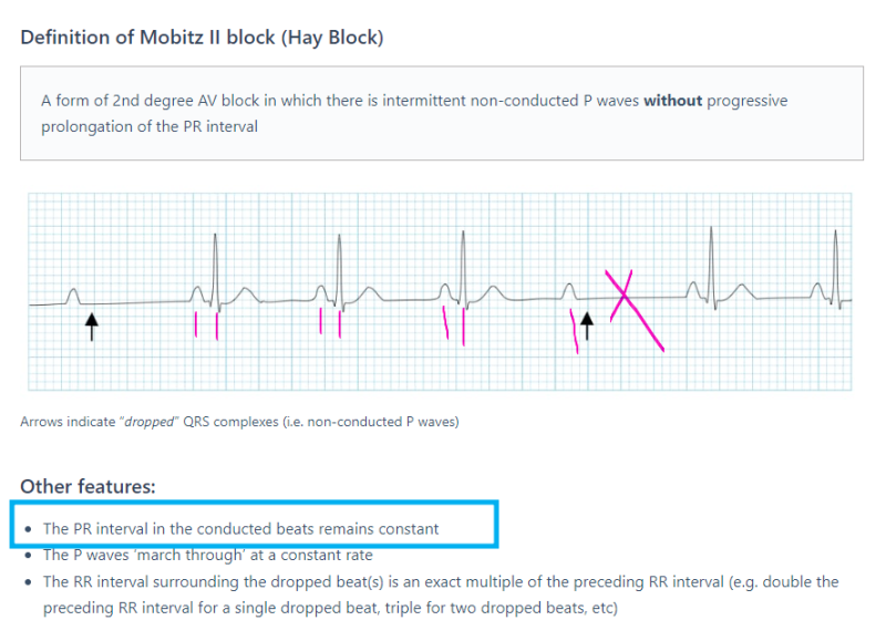 심전도 : 모비츠 1형과 2형 감별 시 도움이 되는 소견 : 네이버 블로그