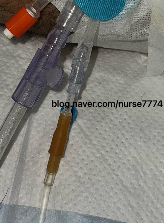 foley ballooning irrigation leakage 공부해보자 : 네이버 블로그