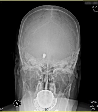 영상의학과 일반촬영 시리즈 X-Ray Series(SKULL,PNS,MANDIBLE,CTL-SPINE,SACRUM,COCCYX ...