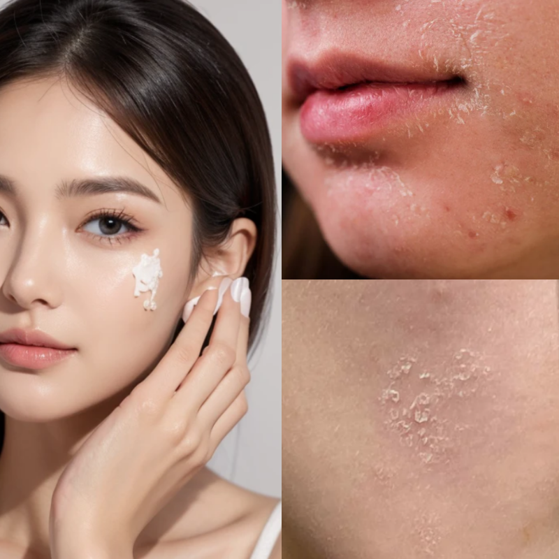 얼굴 버짐 피부 입가 마른버짐 원인 7가지 없애는법 네이버 블로그