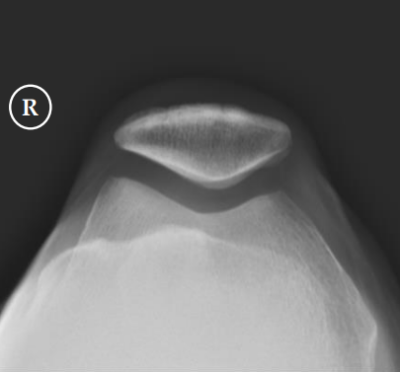 Knee AP,PA,ROSENBERG(Both Lat, Merchant)촬영법 무릎관절 X-RAY검사법 소개 : 네이버 블로그