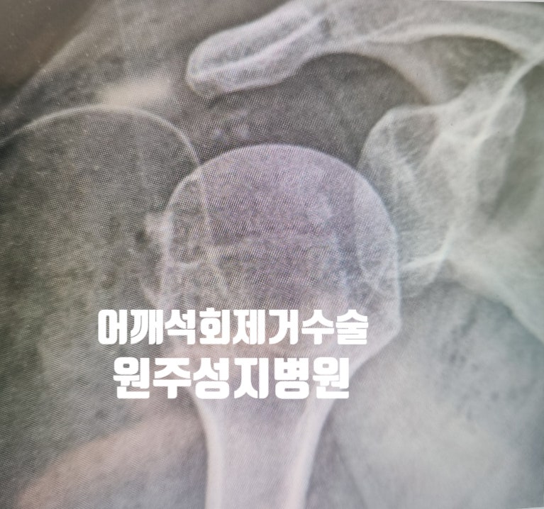 석회화건염 어깨통증 석회제거 수술후기 원주 성지병원수술사진포함 네이버 블로그