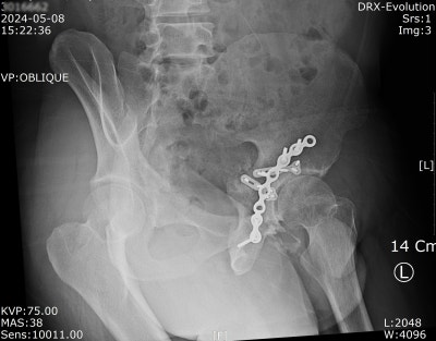 PELVIS AP, OBL,INLET,OUTLET,HIP JOINT 골반일반 촬영법 소개 : 네이버 블로그